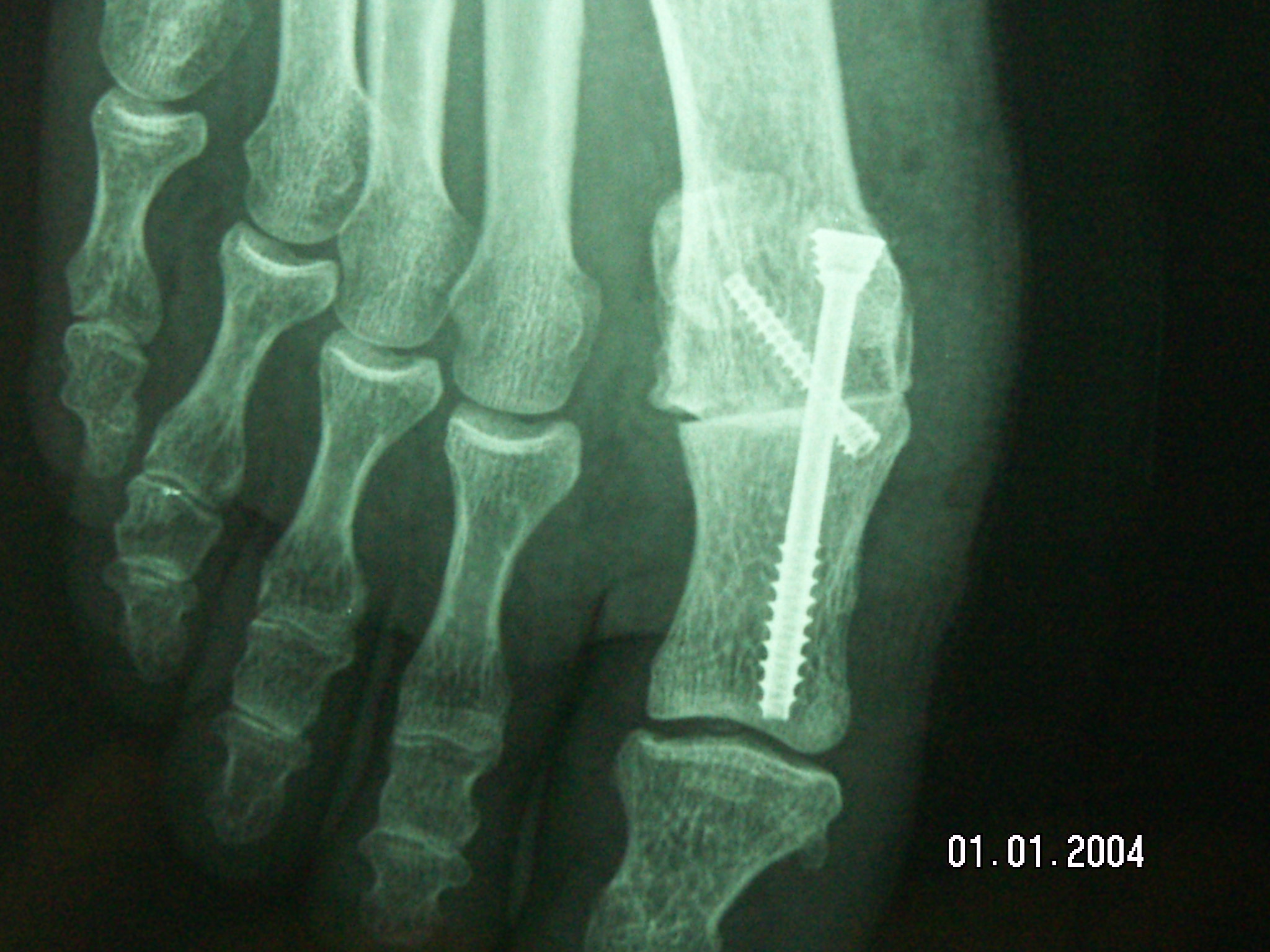 hallux rigidus ou arthrose métatarsophalangienne du gros orteil