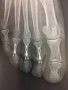 orteil en griffe aussi appelé griffe d'orteil déformation fréquente
